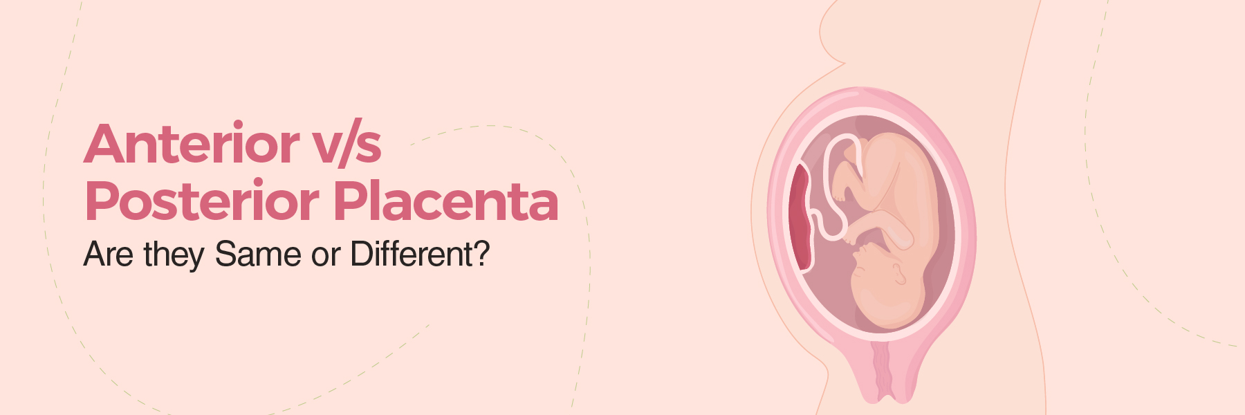 Anterior and Posterior Placenta: Similarities and Differences