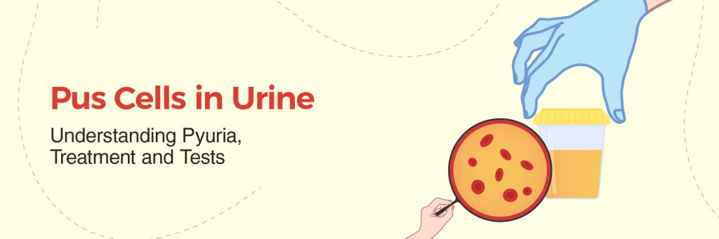 Pus Cells in Urine: Causes, Symptoms, Tests & Treatment